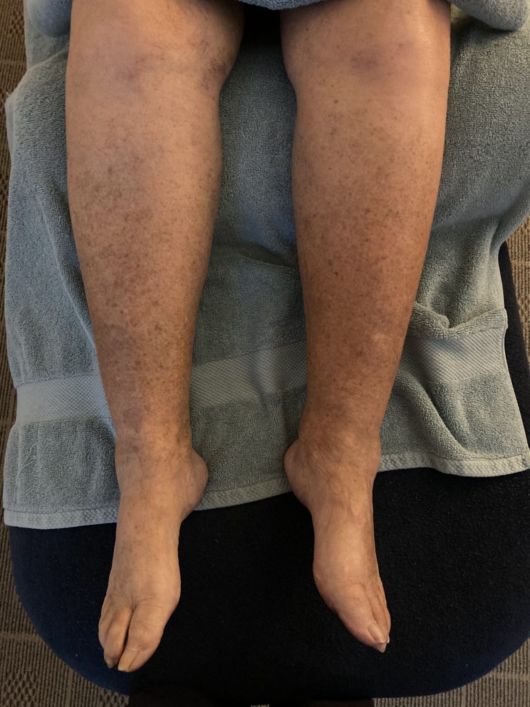 Manual Lymphatic Drainage and stress fracture healing | Lisa Higgins